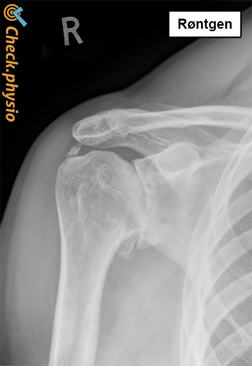 Årsak, symptomer & behandling | Skulderartrose - Physiocheck.no